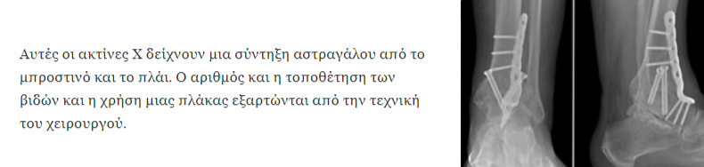 Ρευματοειδής αρθρίτιδα του ποδιού