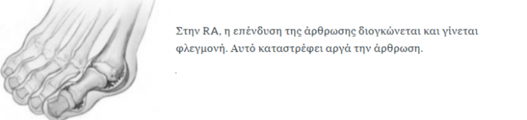 Ρευματοειδής αρθρίτιδα του ποδιού